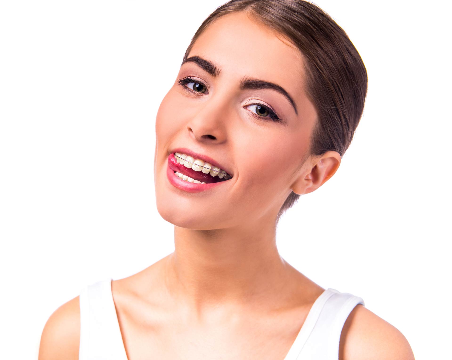 Brackets estéticos – Denticlinic